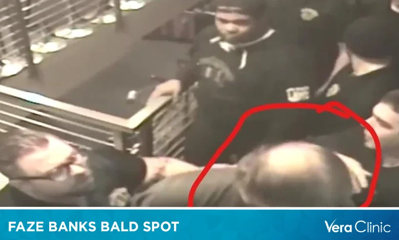 FaZe Banks Hair Transplant