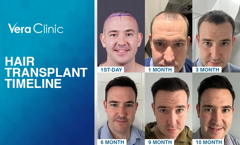 Hair Transplant Recovery Timeline