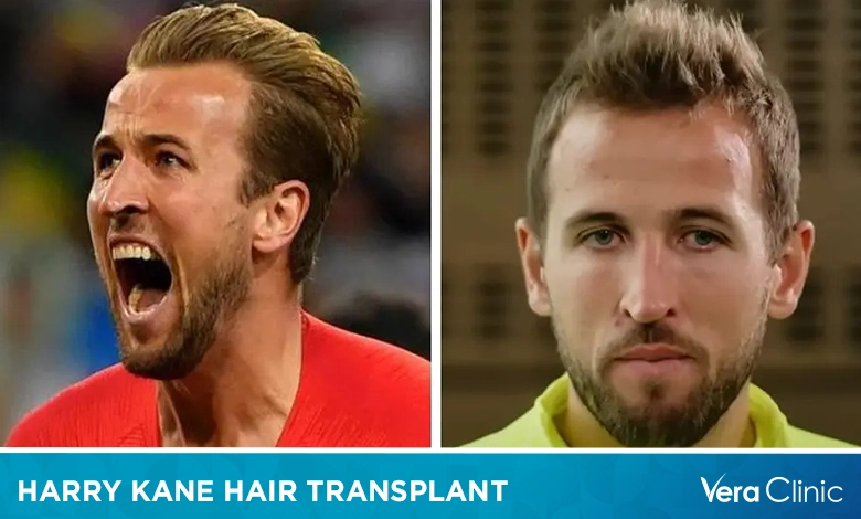 Harry Kane Hair Transplant