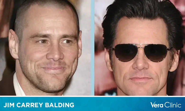 Jim Carrey Hair Transplant