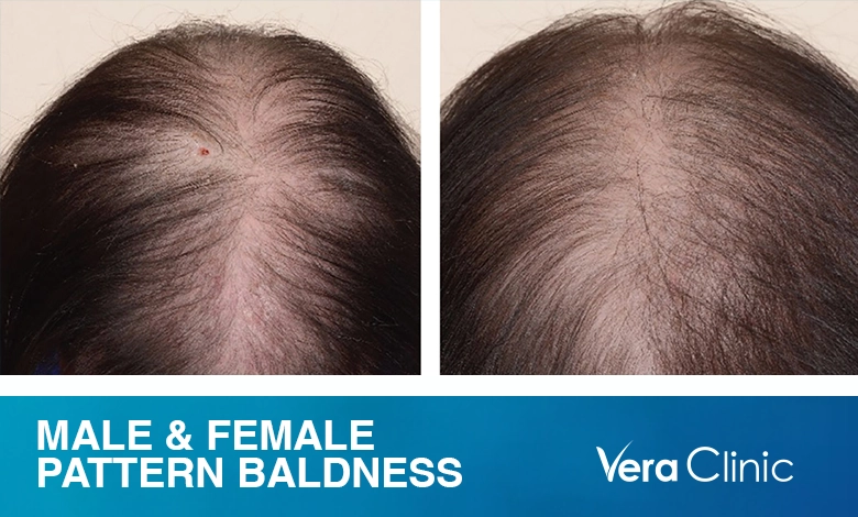 Male Pattern Baldness & Female Pattern Baldness