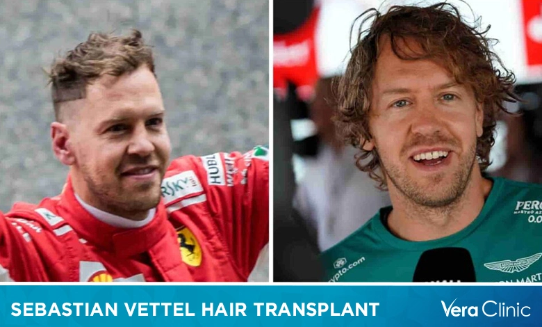 Sebastian Vettel Hair Transplant