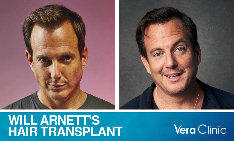 Will Arnett Hair Transplant