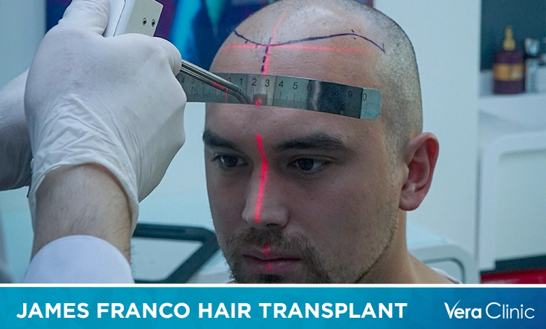 Hairline Lowering Surgery: A Detailed Guide