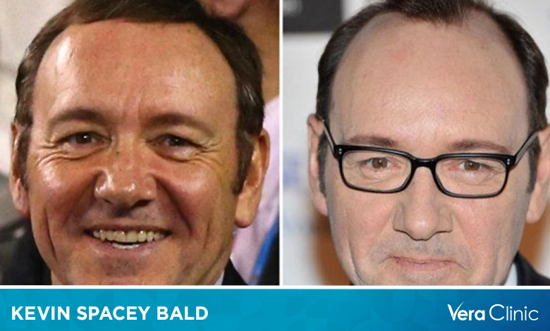Kevin Spacey Hair Transplant