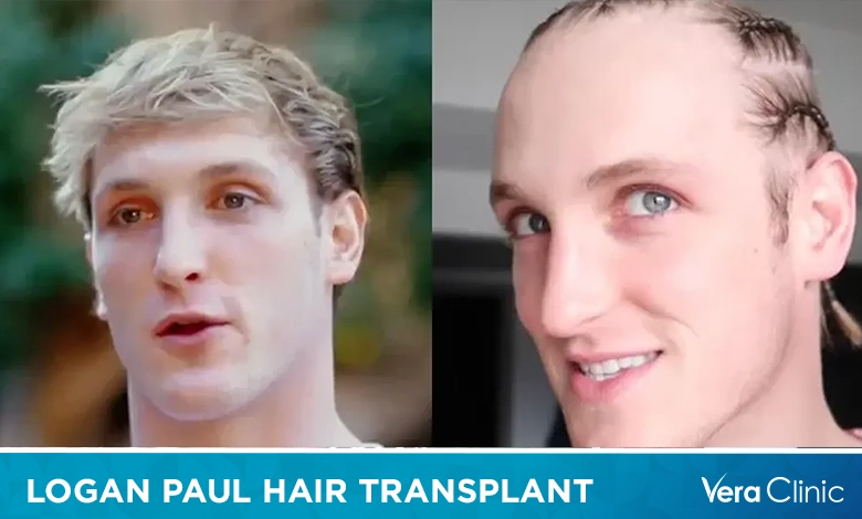 Logan Paul Hair Transplant
