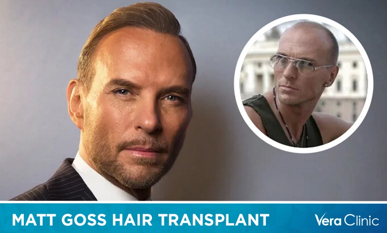 Matt Goss Hair Transplant: The Mystery Behind His Journey
