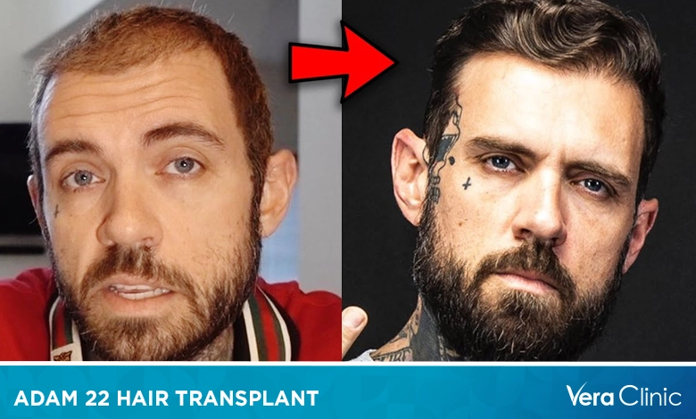 Adam22 Hair Transplant