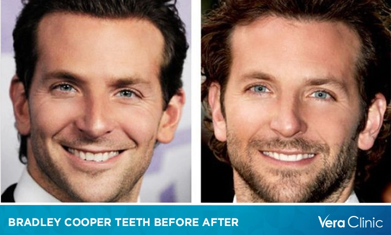 Bradley Cooper Teeth Before and After: Dental Transformation