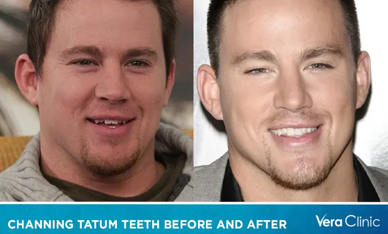 Channing Tatum Teeth Before and After: Unveiling the Transformation