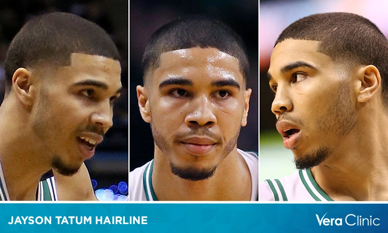 Jayson Tatum Hair Transplant
