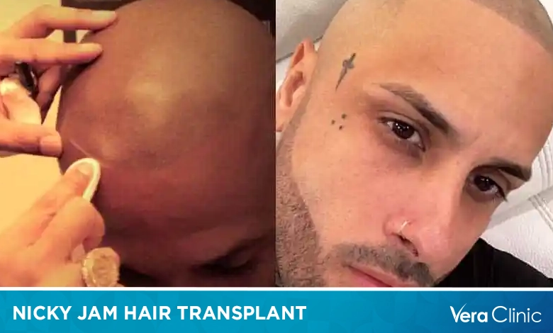 Nicky Jam Hair Transplant