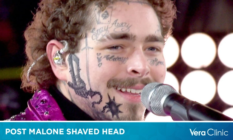 Post Malone Hair Transplant