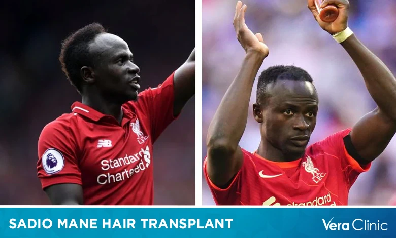 Sadio Mané Hair Transplant