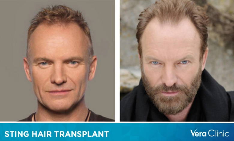 Sting Hair Transformation