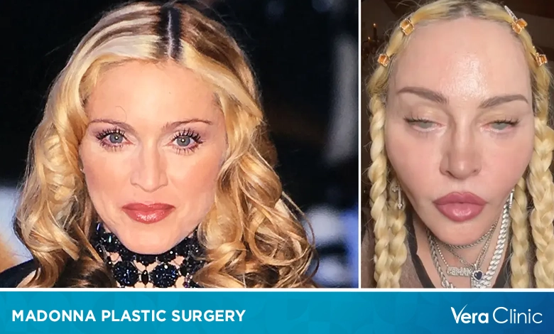 Madonnas Plastic Surgery makes her young again removing decades of ...