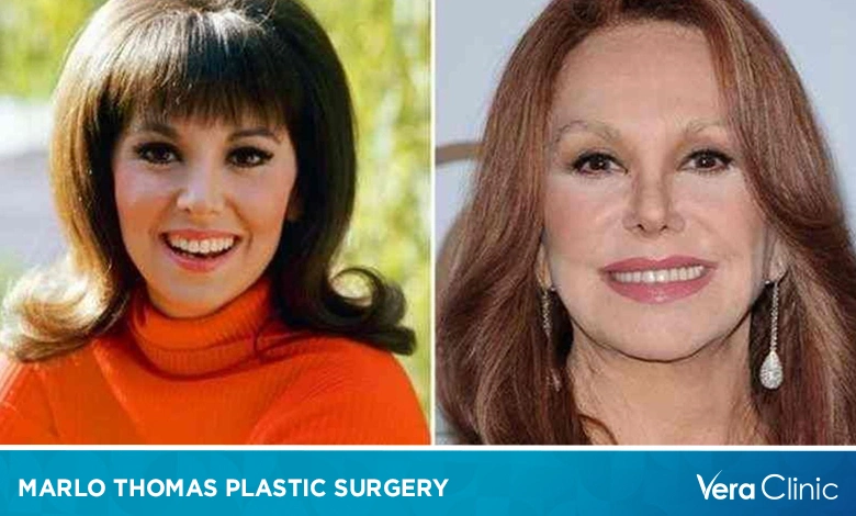 Marlo Thomas Plastic Surgeries, Before and After