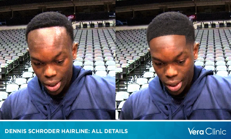 Dennis Schroder Hairline: All Details