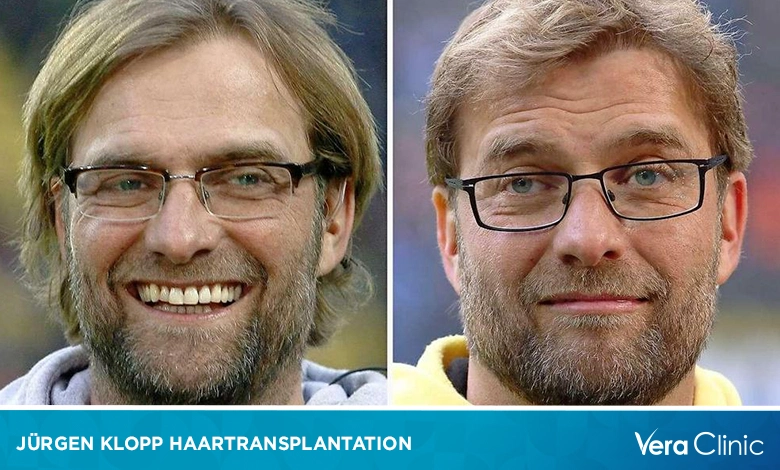 Jürgen Klopp Haartransplantation": Ein genauerer Blick auf seine ...