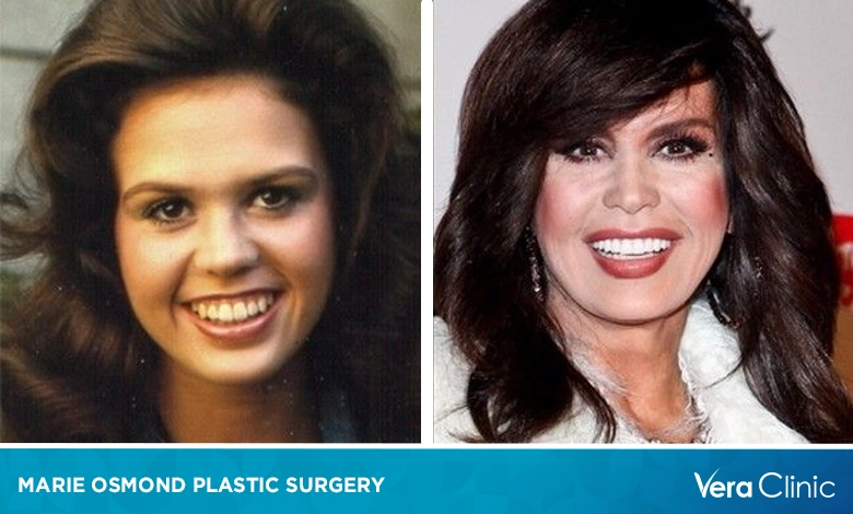 Marie Osmond Plastic Surgeries, Before and After