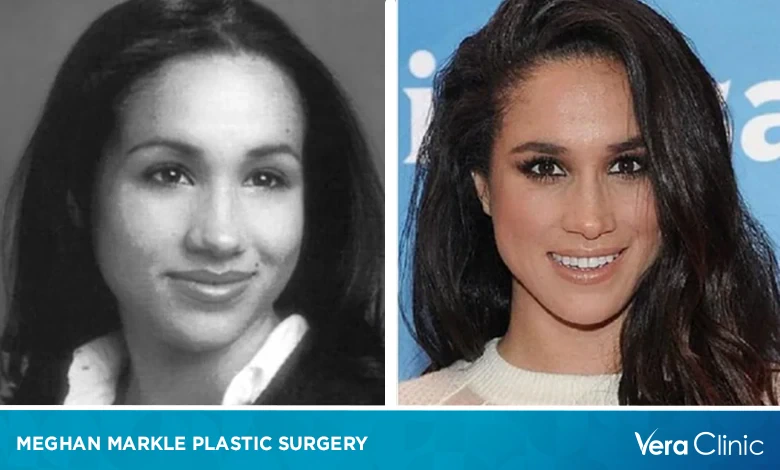 Meghan Markle Plastic Surgeries, Before and After