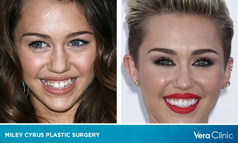 Miley Cyrus Plastic Surgery: A Comprehensive Look