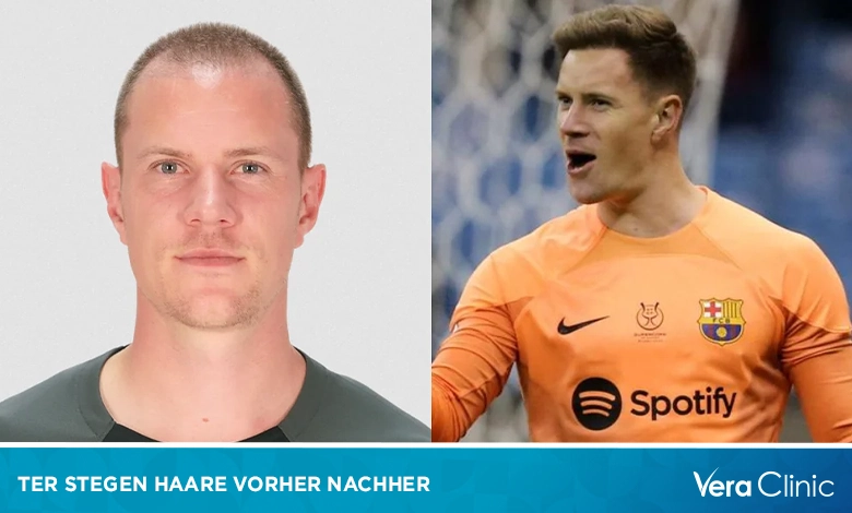 Eine Haartransplantation Reise: Ter Stegen Haare Vorher Nachher