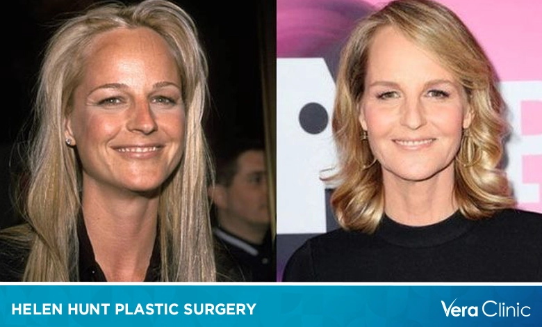 Helen Hunt Plastic Surgeries, Before and After