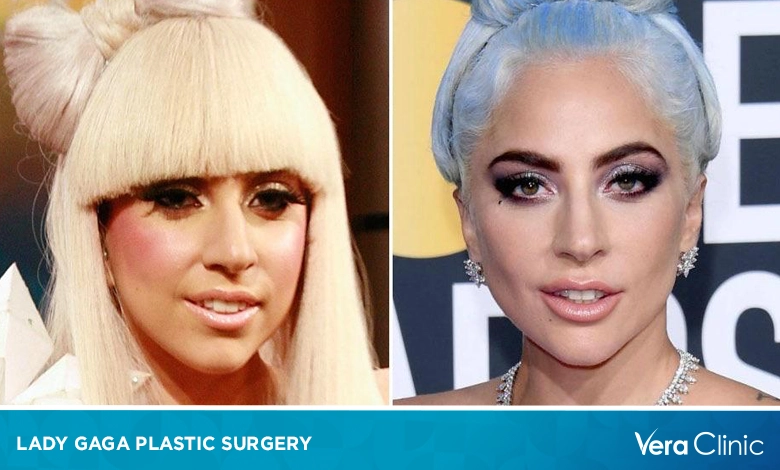 Lady Gaga Plastic Surgery: Unveiling the Transformation