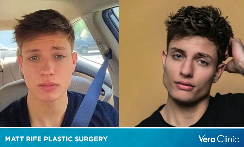 Matt Rife Plastic Surgeries, Before and After