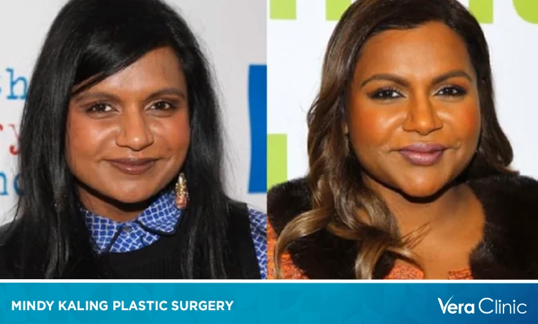 Mindy Kaling Plastic Surgeries, Before and After