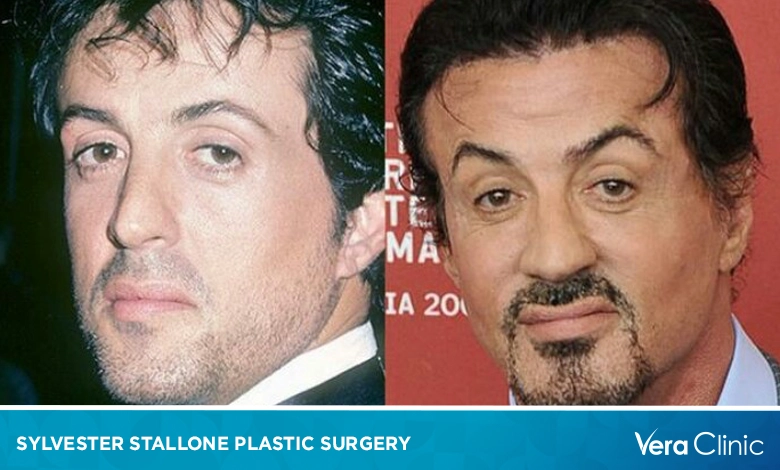 Sylvester Stallone Plastic Surgery: Age-Defying Appearance
