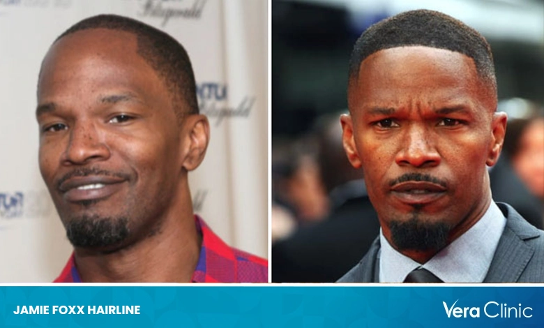 Jamie Foxx Hairline: Explore the Transformation