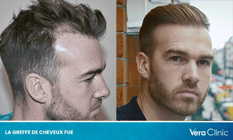 La greffe de cheveux FUE : Une solution moderne contre la calvitie