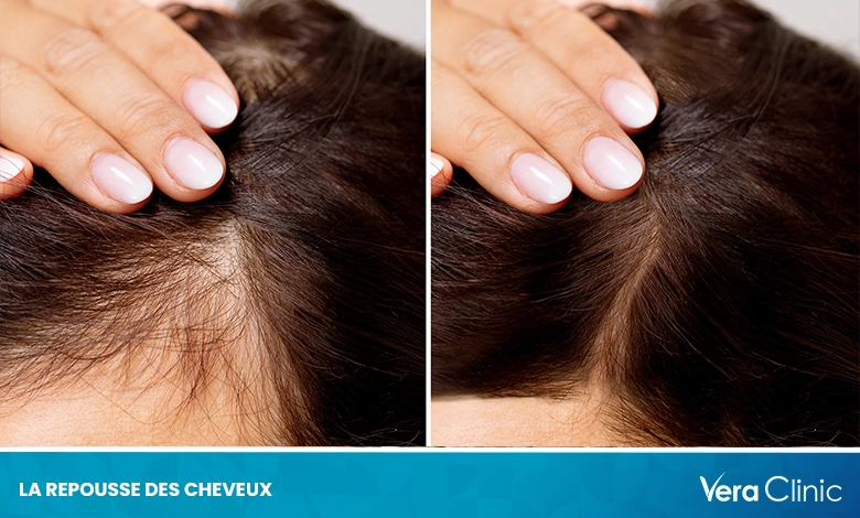 La Repousse des Cheveux : Espoir et Solutions Après la Chimio et Au-delà
