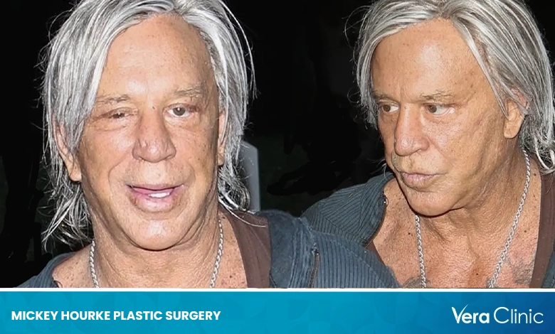 Mickey Rourke Plastic Surgery: A Comparative Analysis