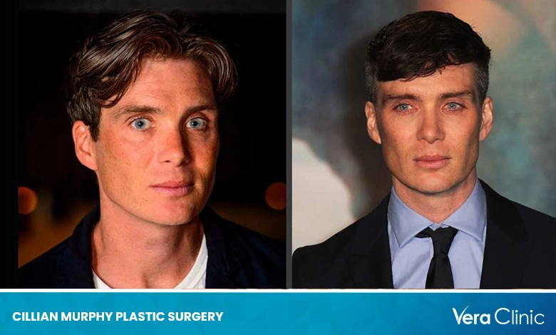 Cillian Murphy Plastic Surgeries, Before and After