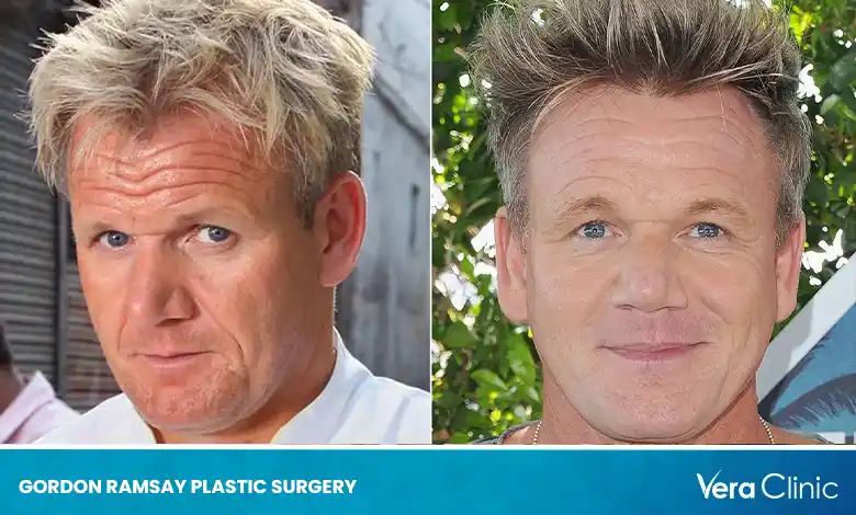 Gordon Ramsay Plastic Surgery: A Close Look Before and After