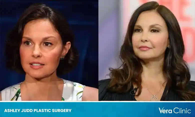 Ashley Judd Plastic Surgeries, Before and After