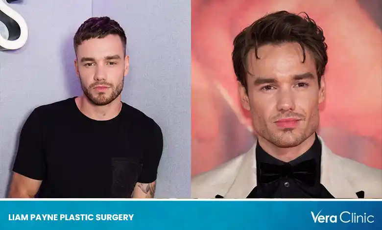 Liam Payne Plastic Surgery: Unveiling the Truth
