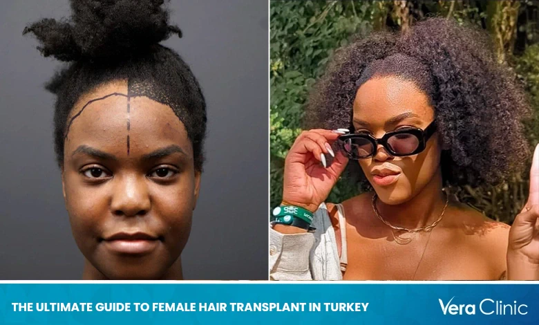 The Ultimate Guide to Female Hair Transplant in Turkey