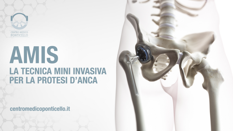 La protesi d'anca mini invasiva | AMIS | Centro Medico Ponticello