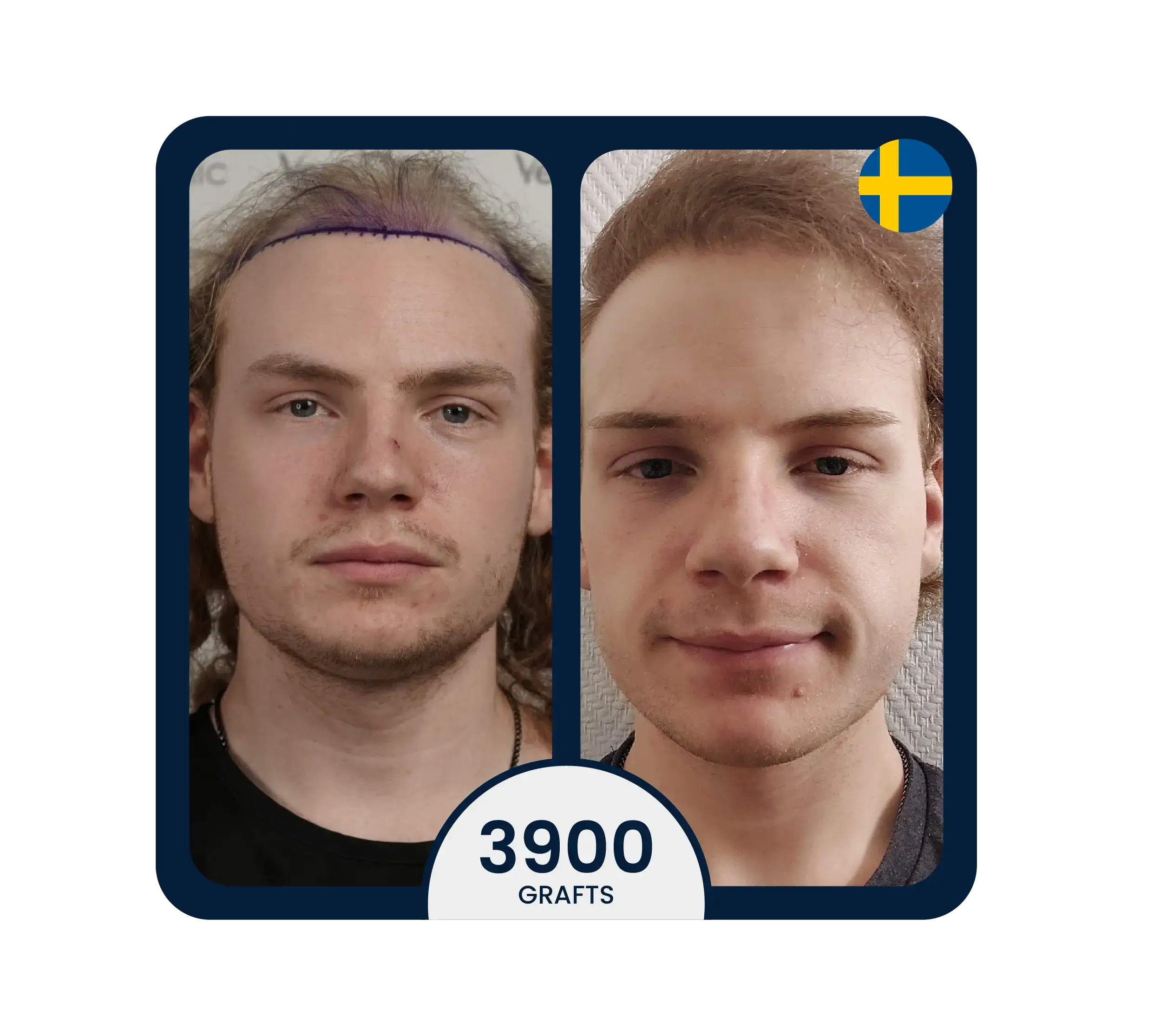 Micro FUE Hair Transplant: Procedure, Benefits, and Aftercare | Vera Clinic