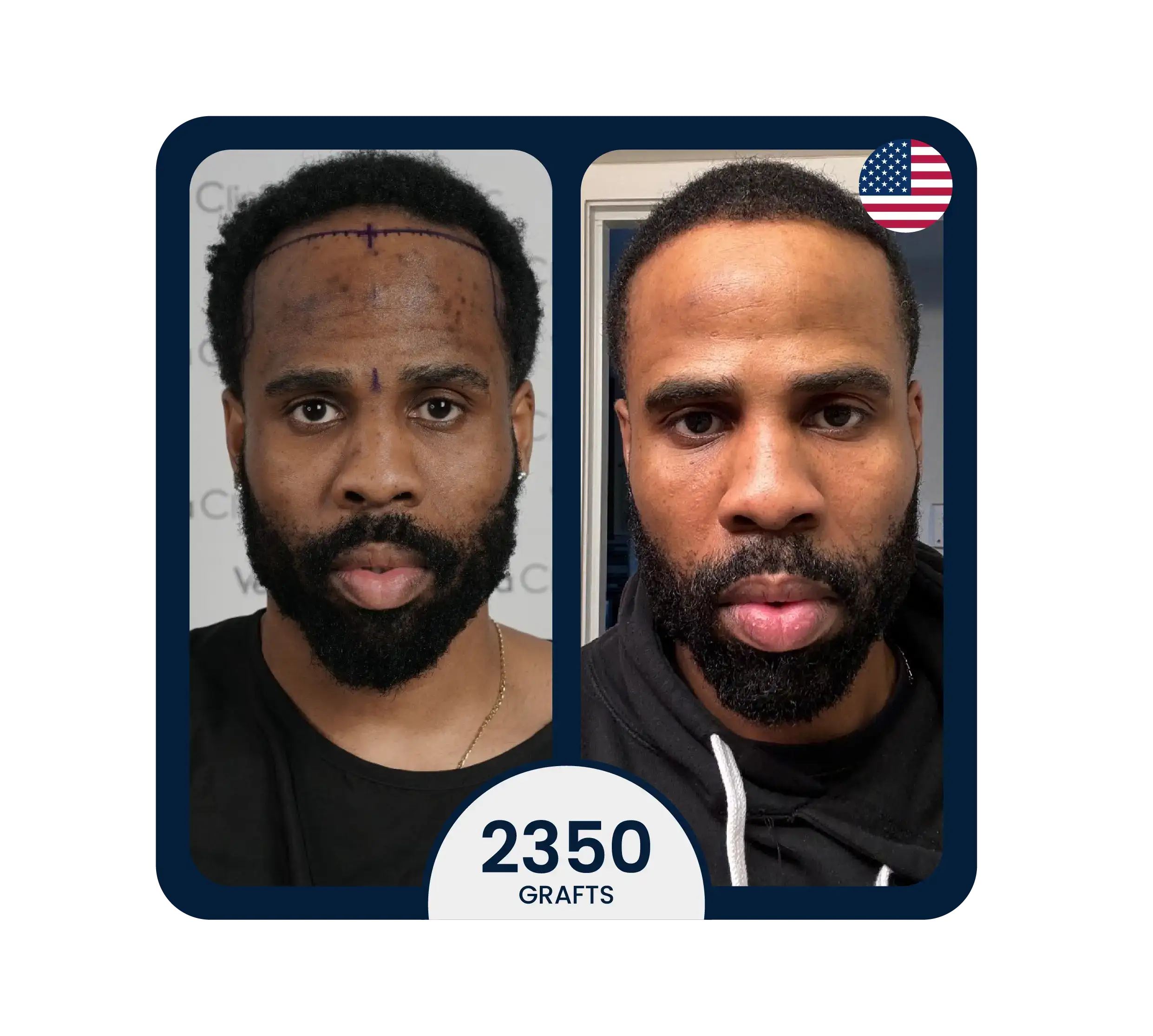 Micro FUE Hair Transplant: Procedure, Benefits, and Aftercare | Vera Clinic