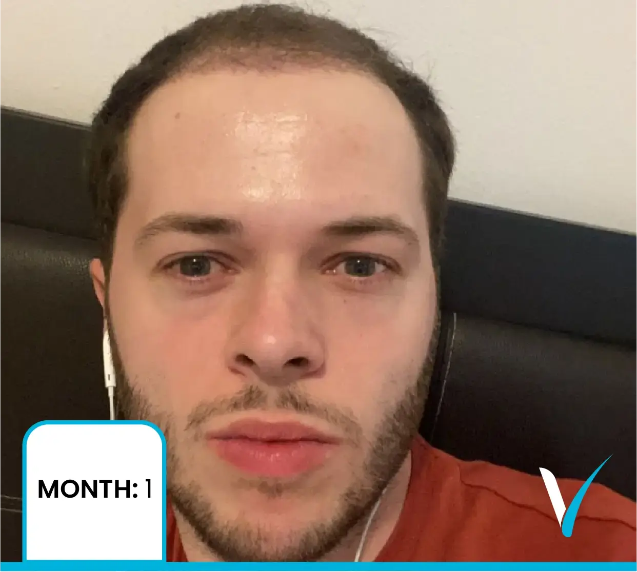 Micro FUE Hair Transplant in Turkey - Vera Clinic