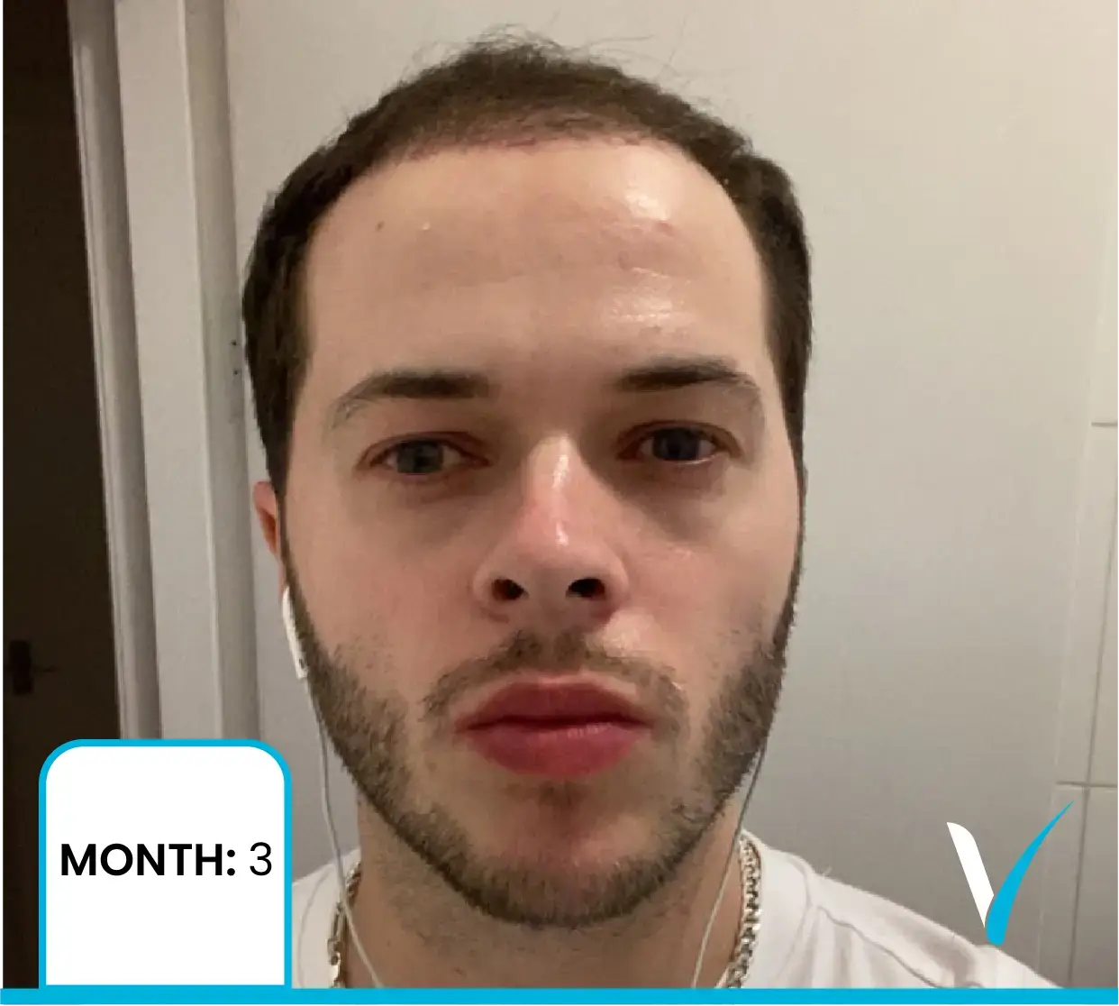 Micro FUE Hair Transplant in Turkey - Vera Clinic