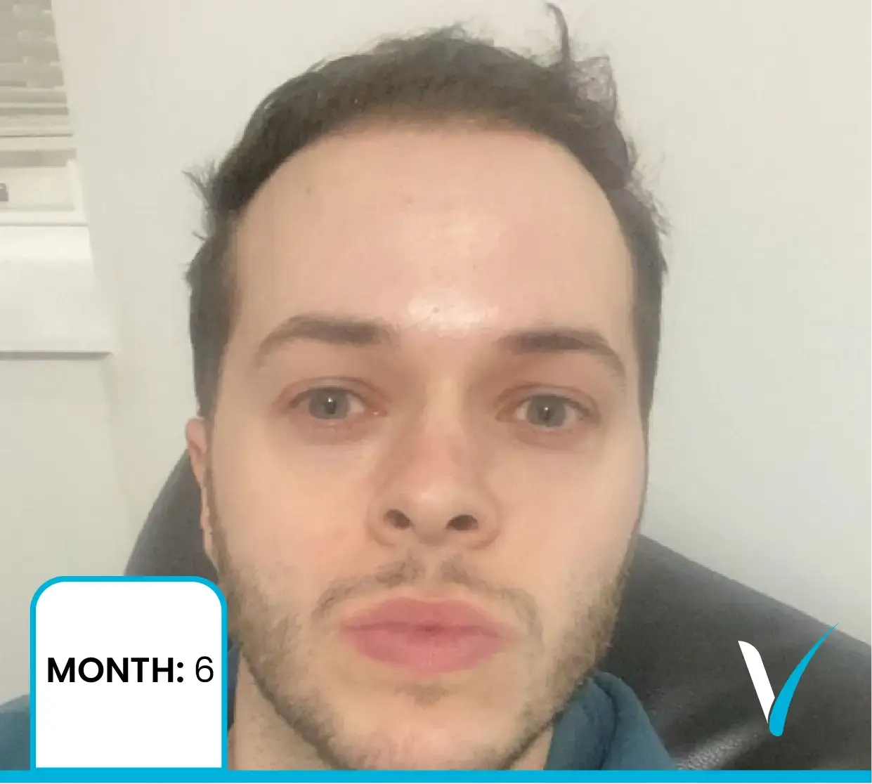 Micro FUE Hair Transplant in Turkey - Vera Clinic