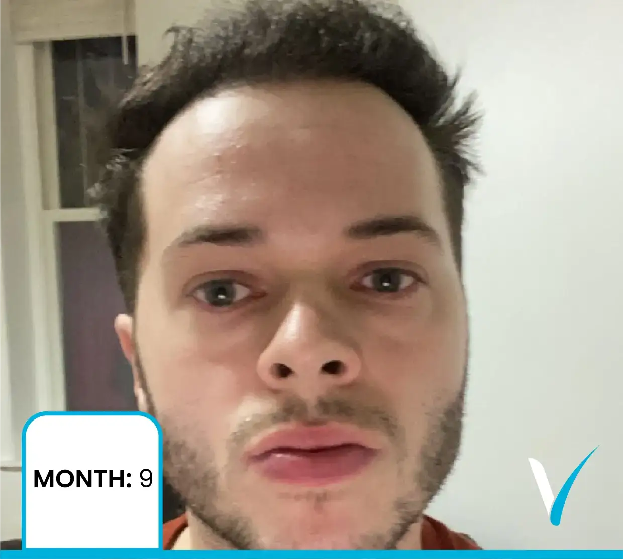 Micro FUE Hair Transplant in Turkey - Vera Clinic