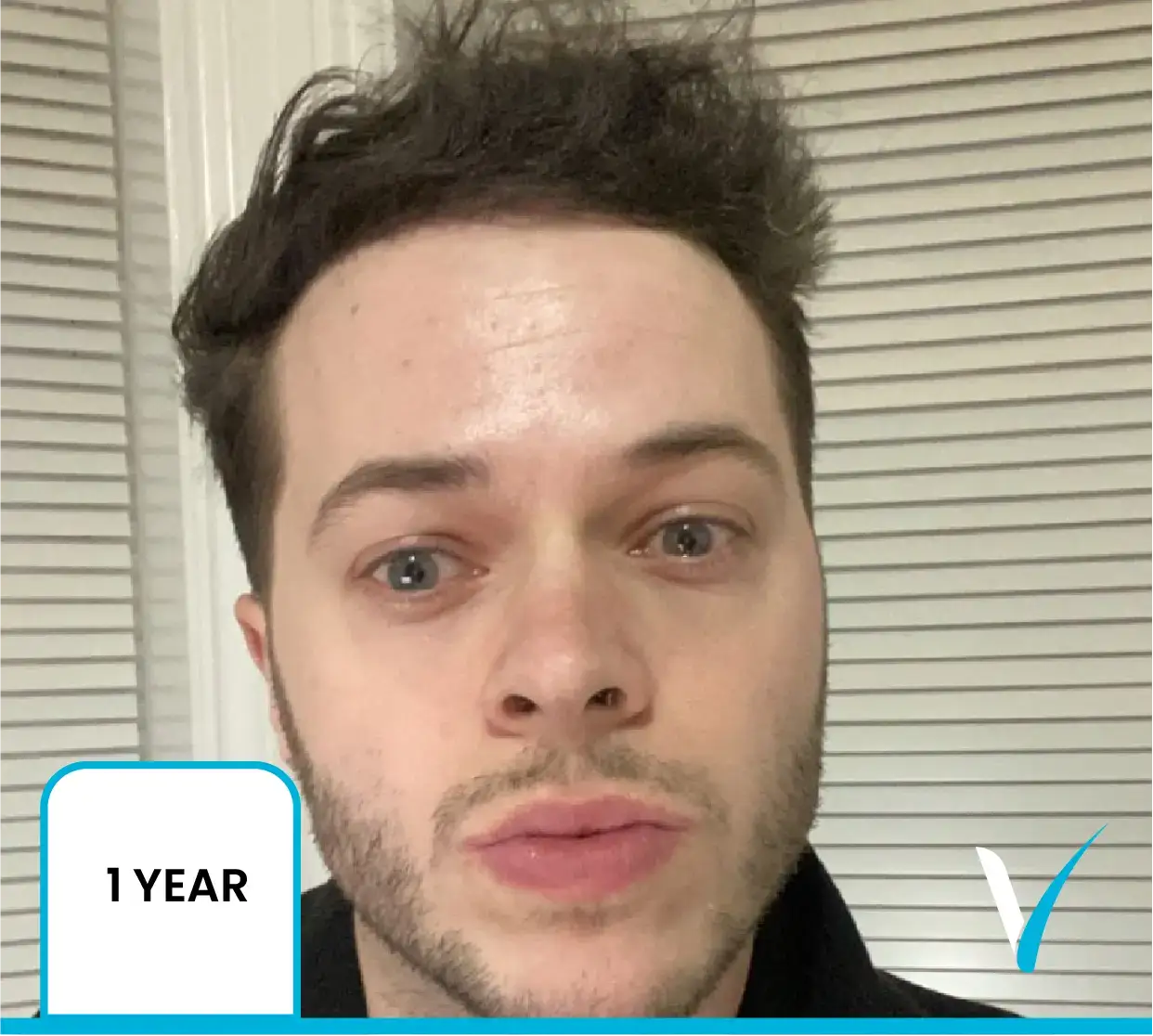 Micro FUE Hair Transplant in Turkey - Vera Clinic