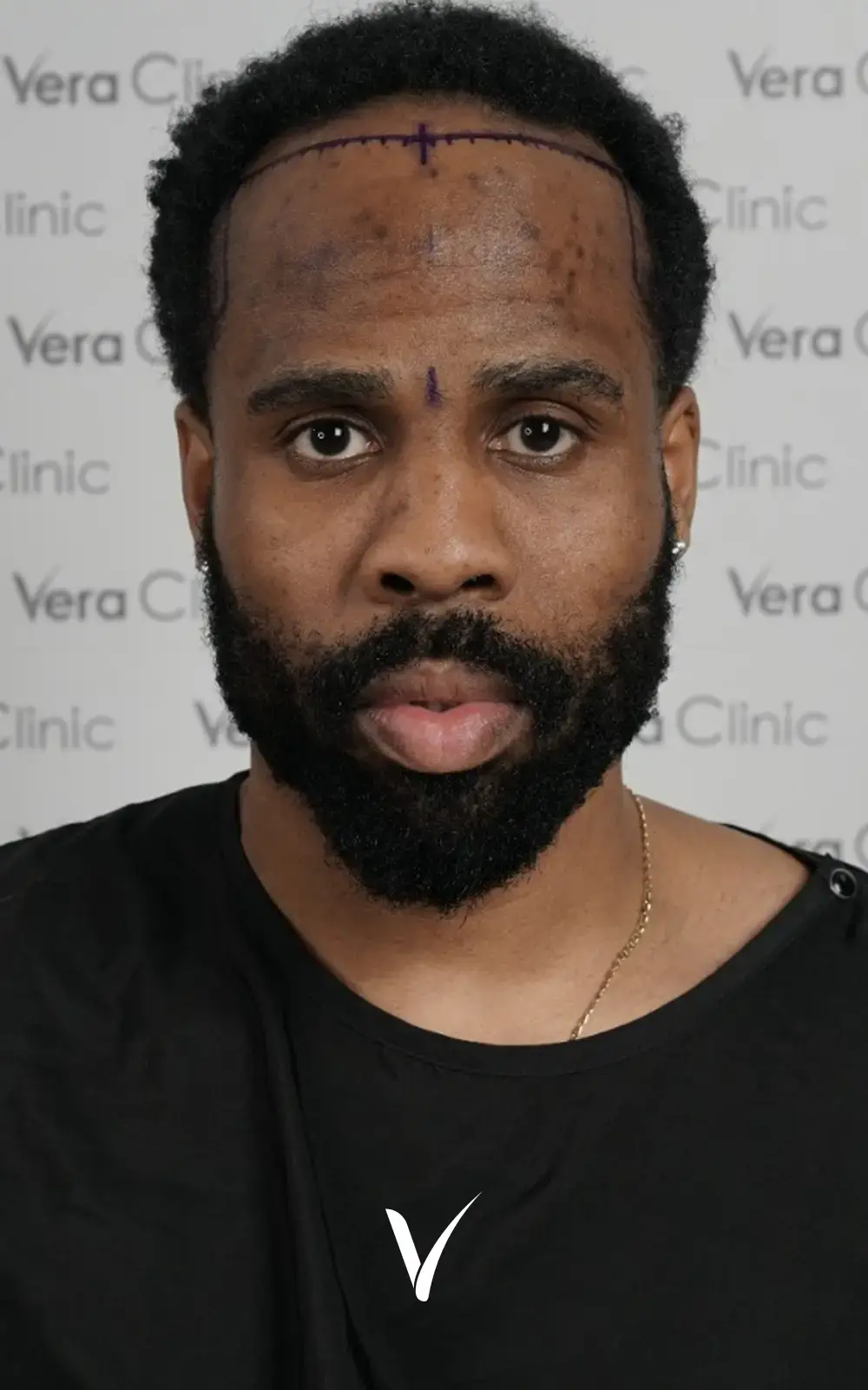 Transplante capilar afro na Turquia - Vera Clinic